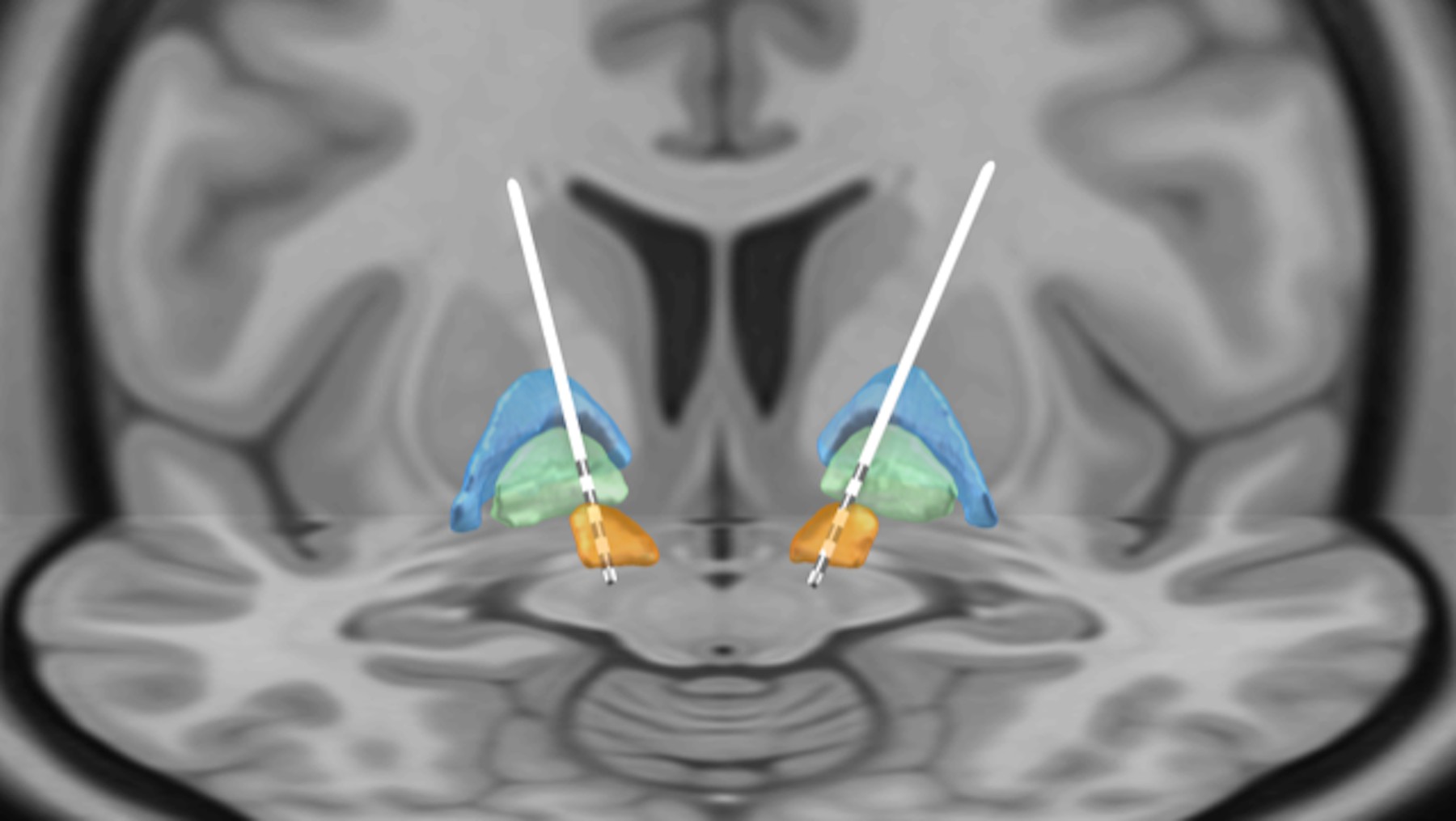 Human deep brain stimulation reduces risky decisions | eLife Science ... Human deep brain stimulation reduces risky decisions | eLife Science ...