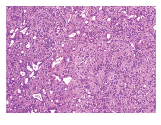 New Insights Into Pancreatic Adenosquamous Carcinoma Elife Science